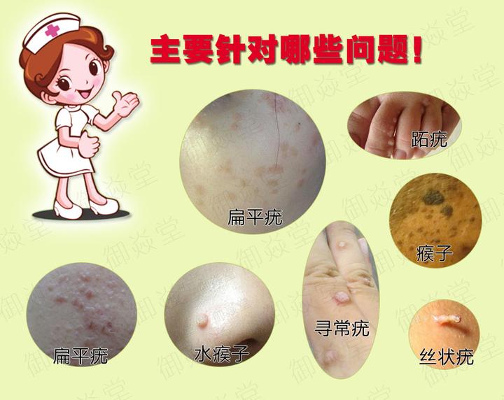 病毒疣的种类有哪些？如何治疗？ 知乎