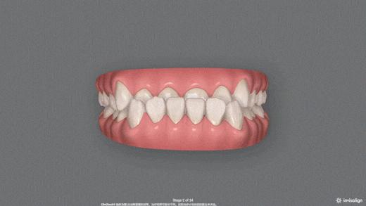 入选Invisalign Global Gallery |成人骨性地包天，非手术+0拔牙+0骨钉，14个月拥有好看侧颜！ - 知乎