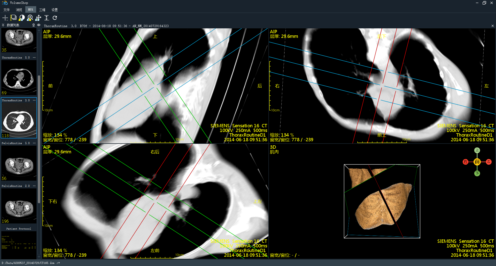 医学影像MPR、MIP、MinIP和AIP介绍 - 知乎