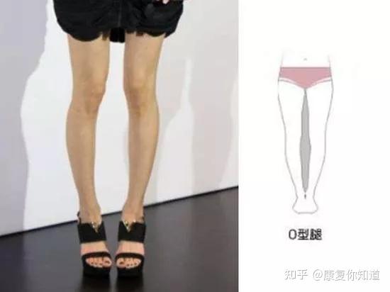 “O”型腿、“X”型腿详解及矫正方案 - 知乎