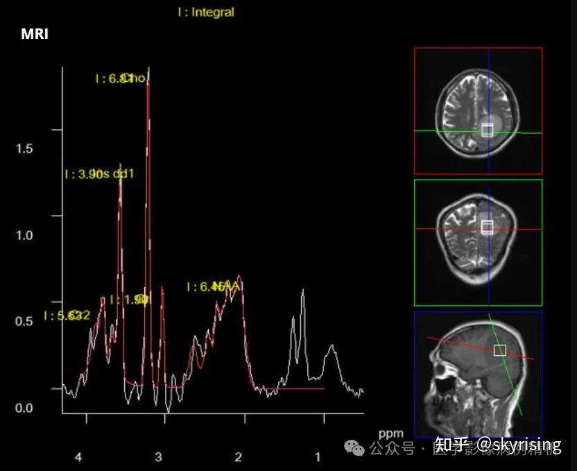 【MRS实战最终版】五例脑实质肿瘤或肿瘤性病变或良性病变MRS影像鉴别诊断并中英文报告模板范例 - 知乎