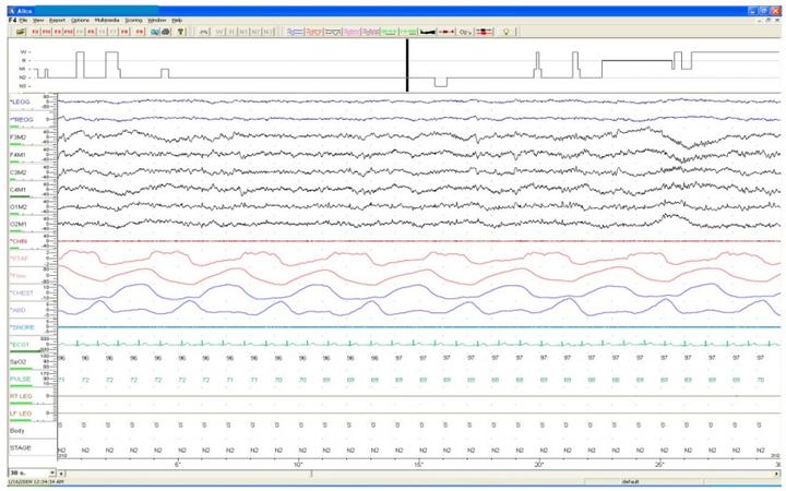 带您解读10000字PSG（睡眠多项生理检查）报告！ 建议收藏 - 知乎