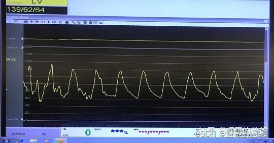 静态心电设备的数据采集（aECG） - 知乎