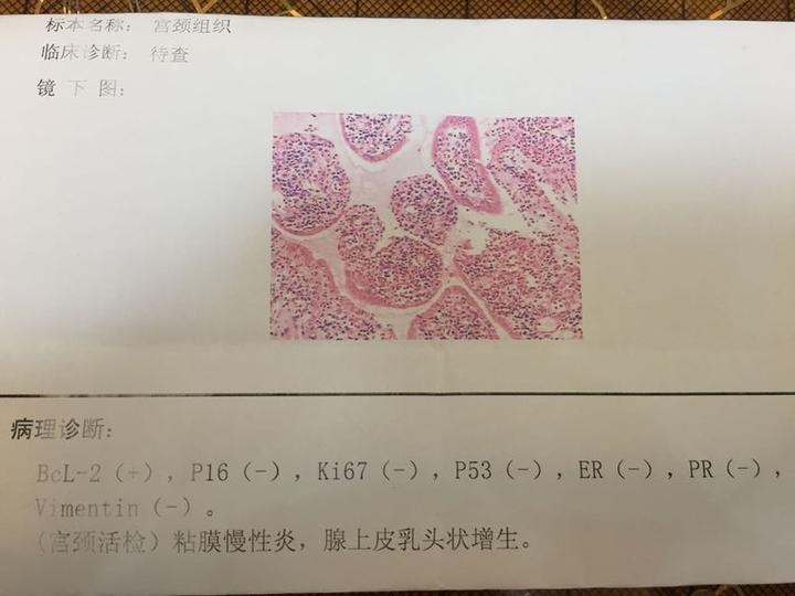 Hpv感染在什么情况下需要做活检 知乎