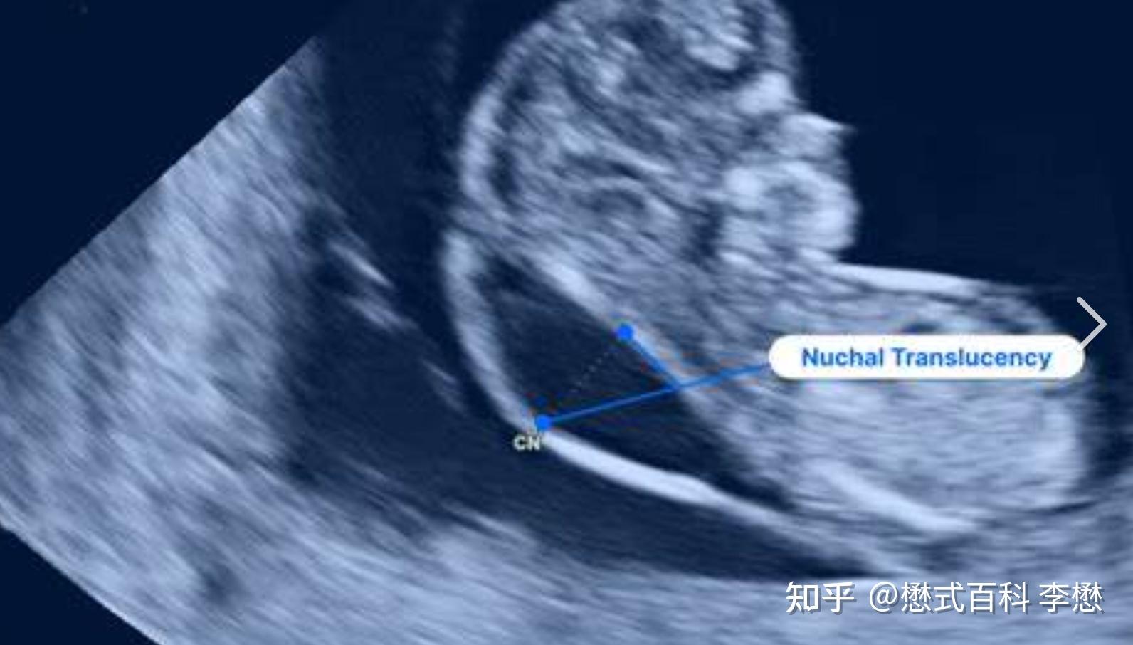 做 nt 检查需要注意哪些事情呢？ - 知乎