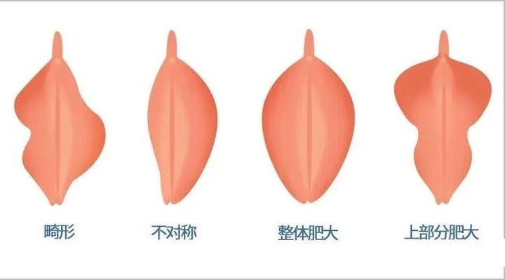 阴唇形状不好看，就要做小阴唇手术吗 知乎