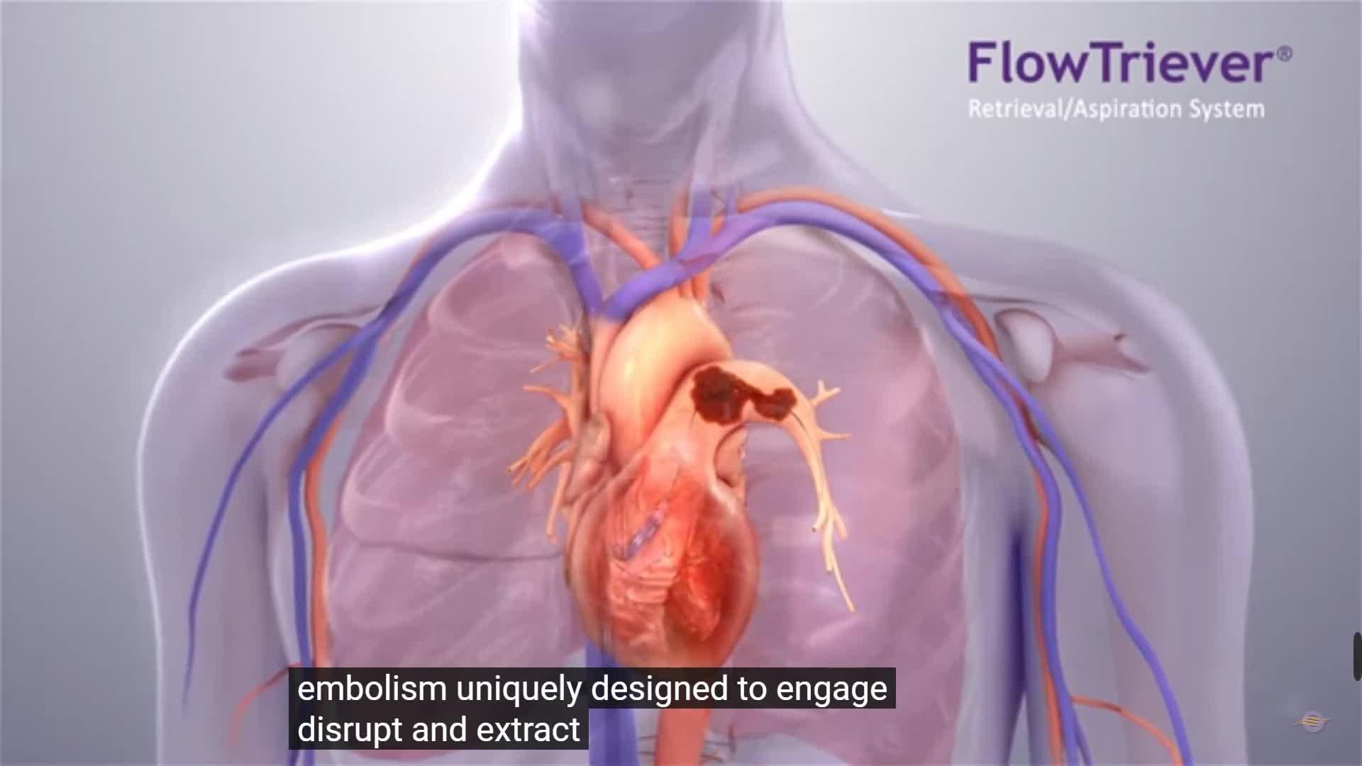 【行业资讯】FlowTriever肺栓塞取栓装置 - 知乎