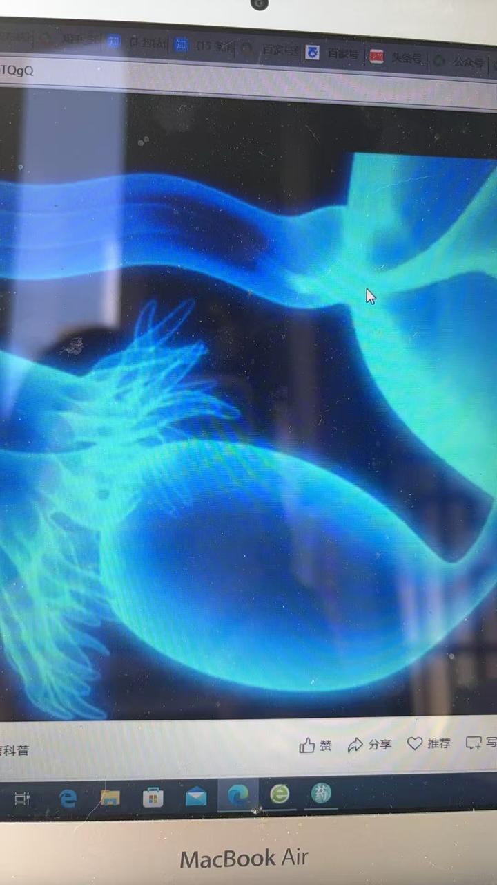 MSI肿瘤治疗新方向：WRN抑制剂RO7589831临床研究，为免疫治疗不足患者带来希望 - 知乎