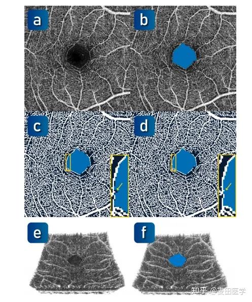 OCTA-500：用于光学相干断层扫描血管造影研究的视网膜数据集|文献速递-基于生成模型的数据增强与疾病监测应用 - 知乎