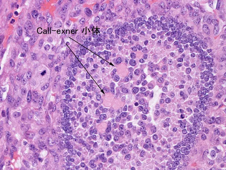 探秘Call-Exner小体【病理诊断须知】 - 知乎