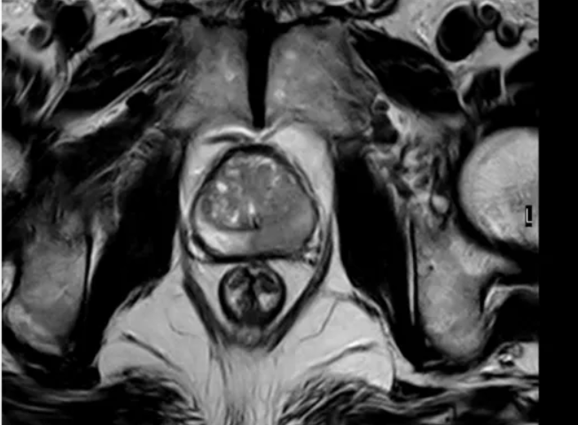 前列腺磁共振中mp-MRI、bp-MRI和abp-MRI - 知乎