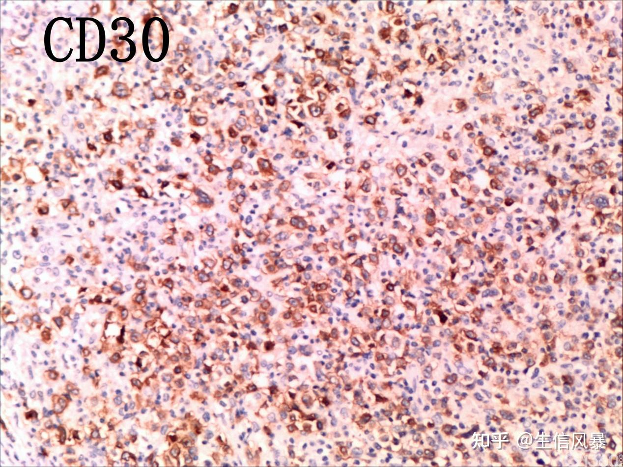 Nature：新的CD30 CAR-T细胞可能是治疗癌症的候选药物 - 知乎