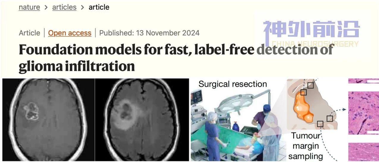 学术动态 | Nature报道结合显微光学成像的FastGlioma模型可在10秒内识别术中脑胶质瘤残余 准确率高达92% - 知乎