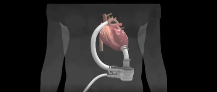 盘点丨为心衰带来希望的LVAD，国内外主流产品有哪些？ - 知乎