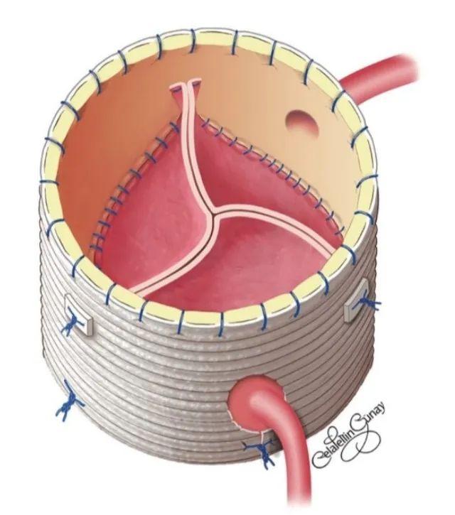 文献速递 | Bentall手术的新替代方案：主动脉瓣Ozaki手术联合Florida袖式主动脉根部重建（附手术视频） - 知乎