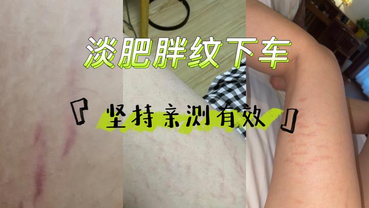 160的身高90斤的体重居然还出现肥胖纹,离谱吗?已经长出来的肥胖纹还能祛除吗? 知乎