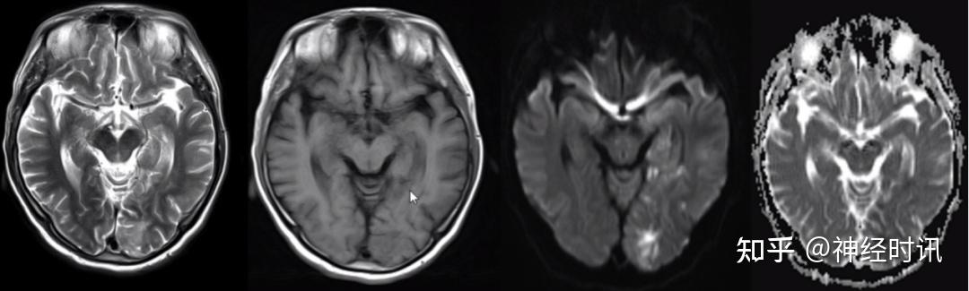 常见脑血管疾病的磁共振成像(MRI)表现！实用，经典！ - 知乎