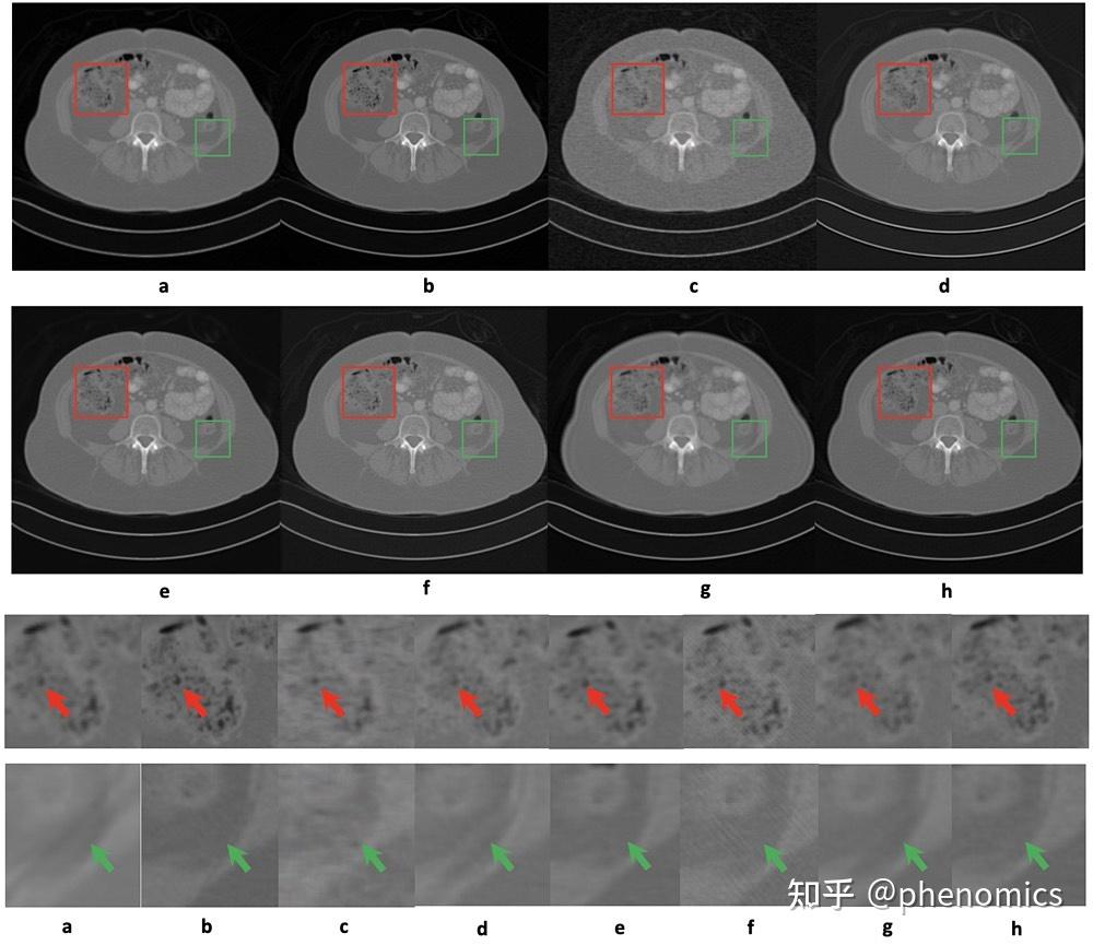 Phenomics| 自监督去噪改善低剂量CT肺结节分类 - 知乎