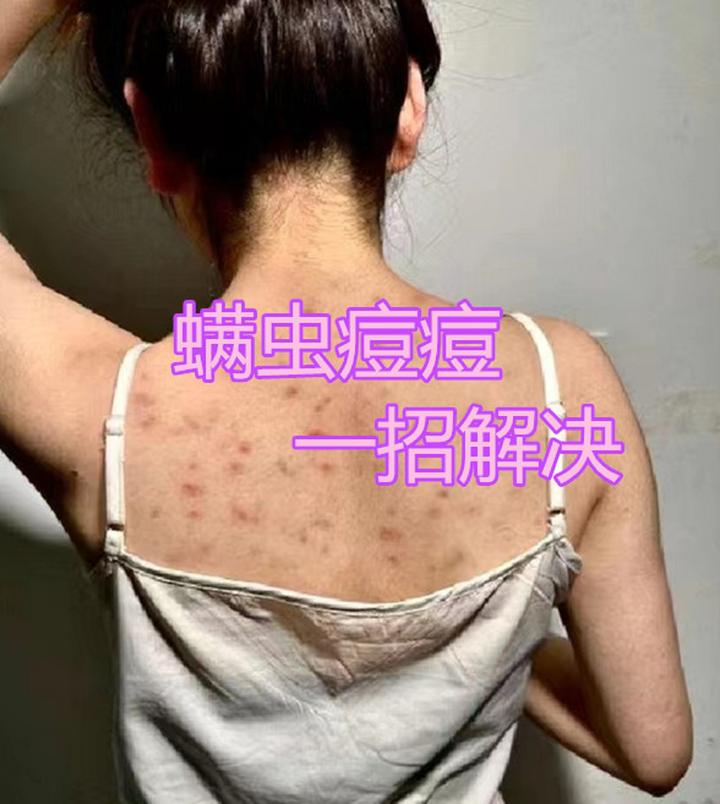 在家就能解决后背痘?每天成本几毛钱!顽固痘痘洗洗就没! 知乎