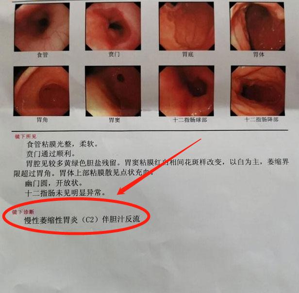 胃镜报告上写的C1、C2、C3是什么意思？严不严重？ - 知乎
