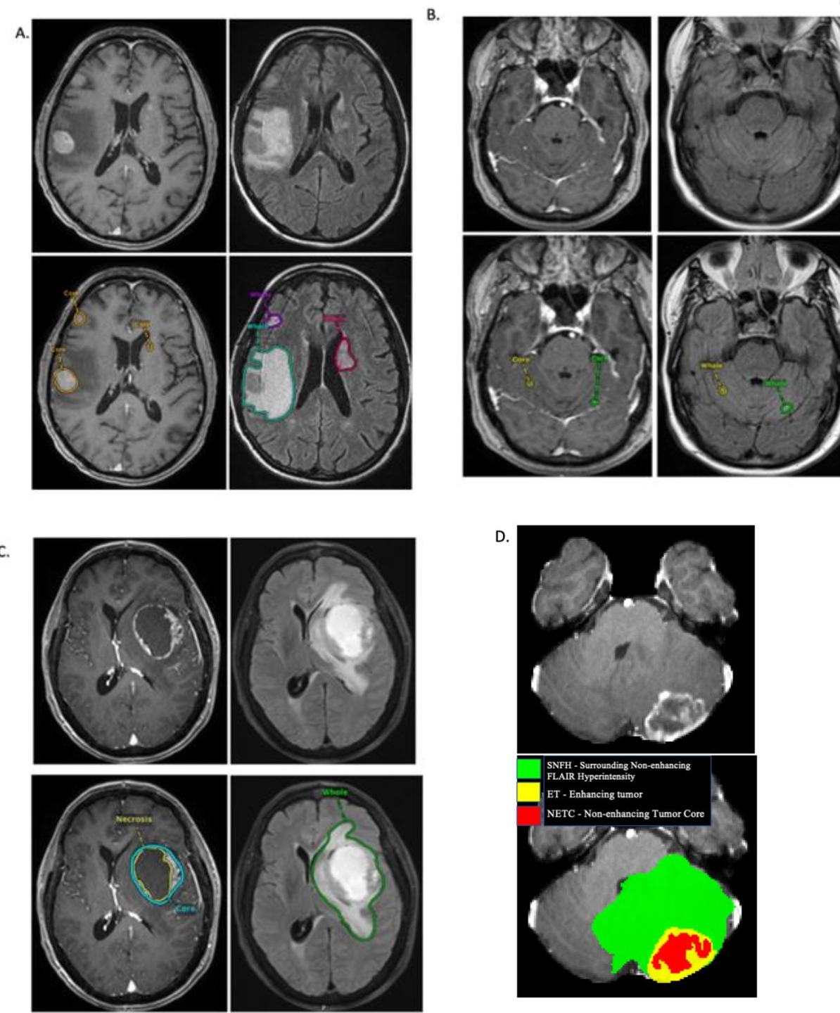 BraTS2023-MET 数据集介绍 - 知乎