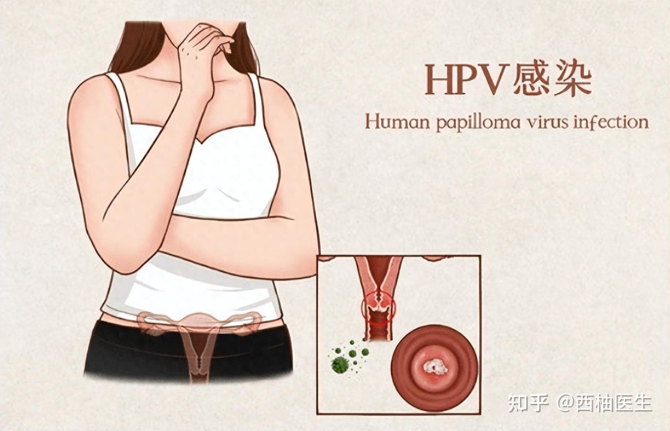 HPV中医怎么治疗？传统中医药在HPV感染防治中的应用 - 知乎