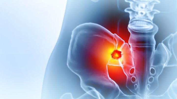 Blenrep联合疗法获英国批准用于多发性骨髓瘤二线治疗 - 知乎