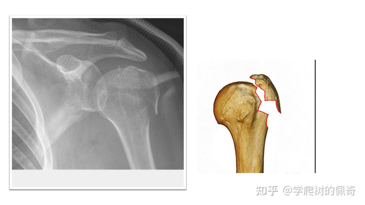 NHANES数据库练手DAY12(酒与骨的研究) - 知乎