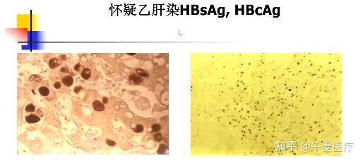 肝穿刺活检病理入门 - 知乎
