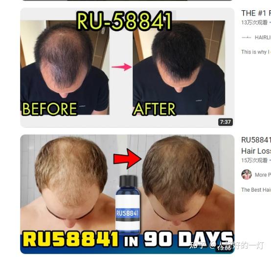 脱发你不得不知道：RU58841 - 知乎