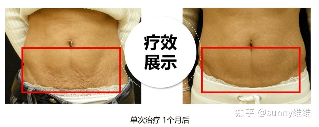 科普|BBL PLUS和光子的区别 - 知乎