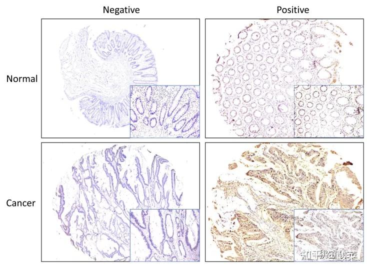 TCGA+GEO单基因生信SCI，15分钟手把手带你复现（内附详细操作教程） - 知乎