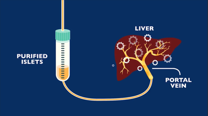 首款糖尿病细胞疗法Lantidra经FDA批准上市 - 知乎