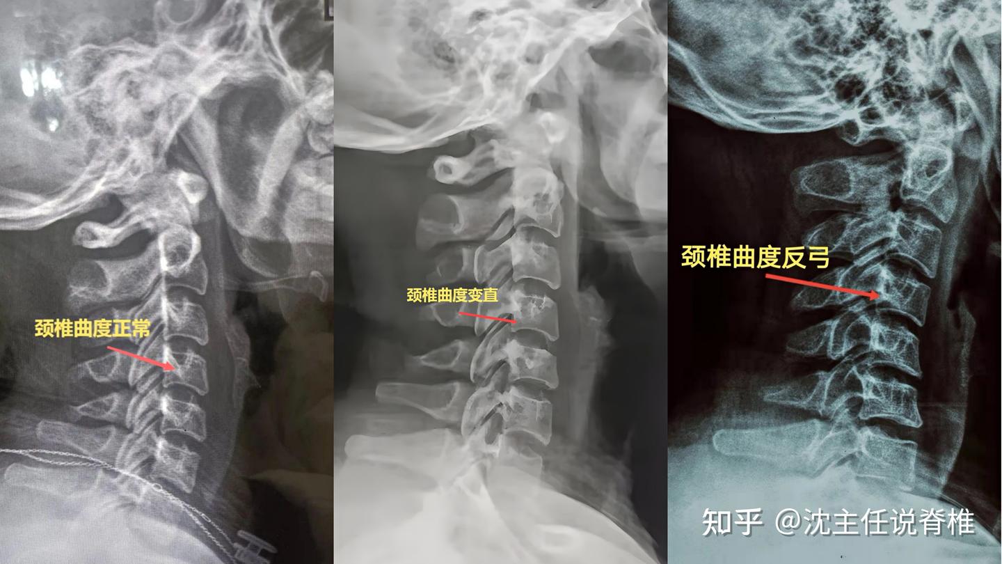 颈椎曲度变直怎么办？医生教你正确预防和锻炼，健康养护颈椎 知乎 6205