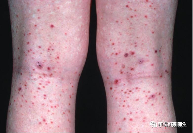 易跟过敏性紫癜混淆的疾病有哪些？（完结篇） - 知乎