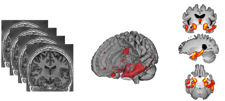 00_医学影像学习_MRI_VBM - 知乎