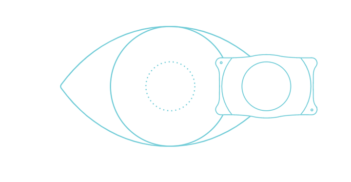 EVO ICL 究竟好在哪？去哪里可以做？ - 知乎