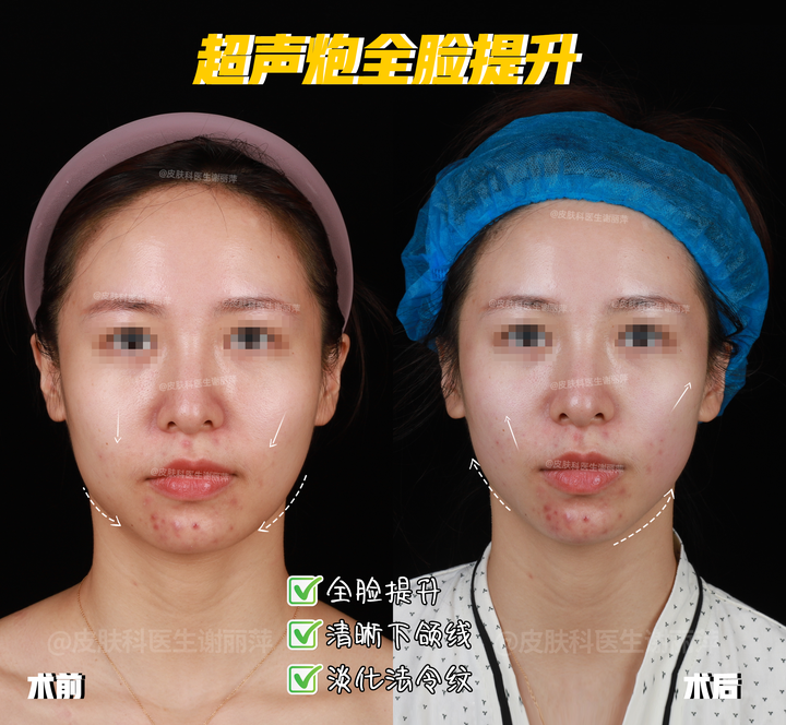 脸瘦的人适合做超声炮吗? 知乎