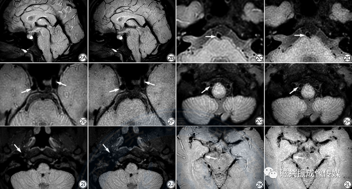 颅内血管壁成像中MSDE序列的参数优化研究 - 知乎