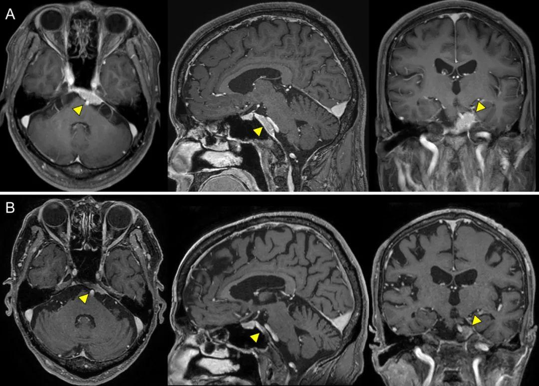 岩斜区脑膜瘤自然消退一例 | JNS案例 - 知乎