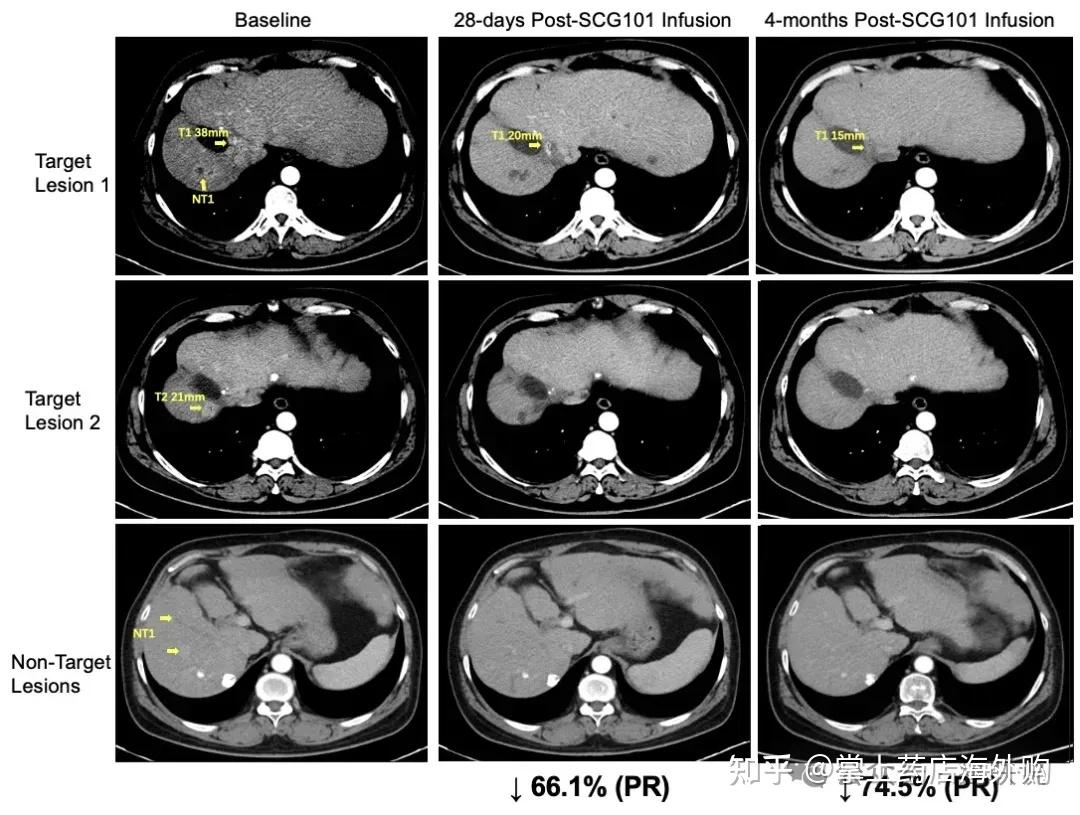 全球首款TCR-T细胞疗法afami-cel获批上市：用于不可切除或转移性滑膜肉瘤患者！患者招募中！ - 知乎
