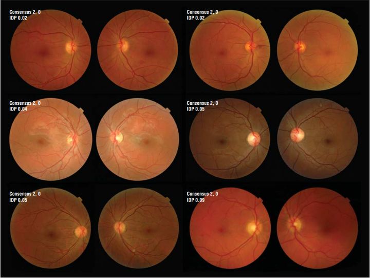 Messidor-2 糖尿病视网膜病变分类数据集介绍 - 知乎