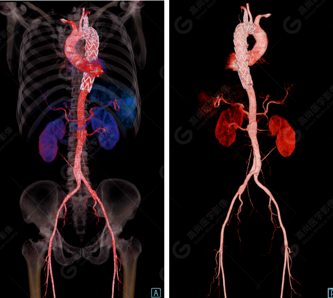 什么是CTA检查？哪些人需要做这个检查？ - 知乎