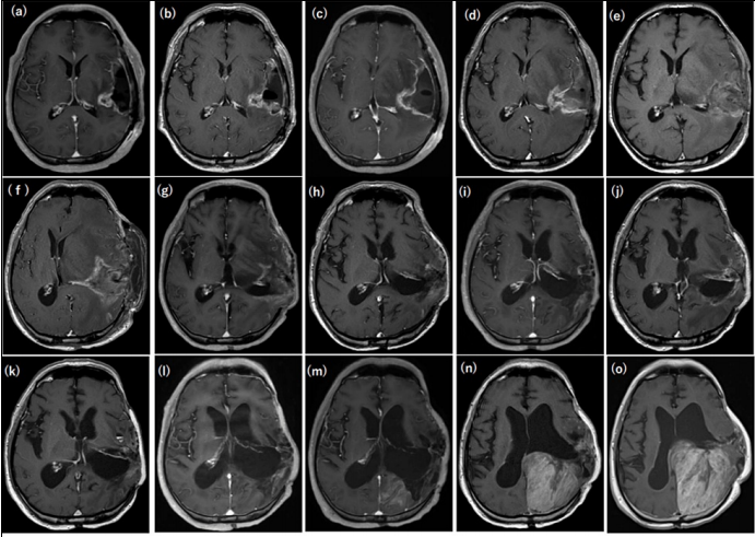 BNCT治疗复发性GBM的个案报道 - 知乎