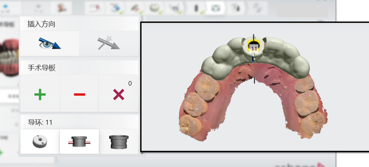 3shape口扫取模和传统取模的区别是什么？优势是什么？ - 知乎