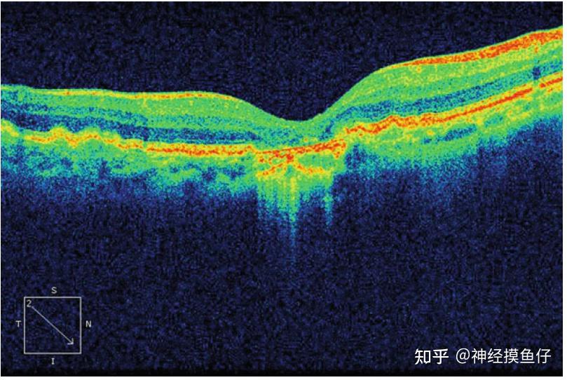 Chen et al. (2019) Retinal OCT Image Analysis 学习笔记 - 知乎