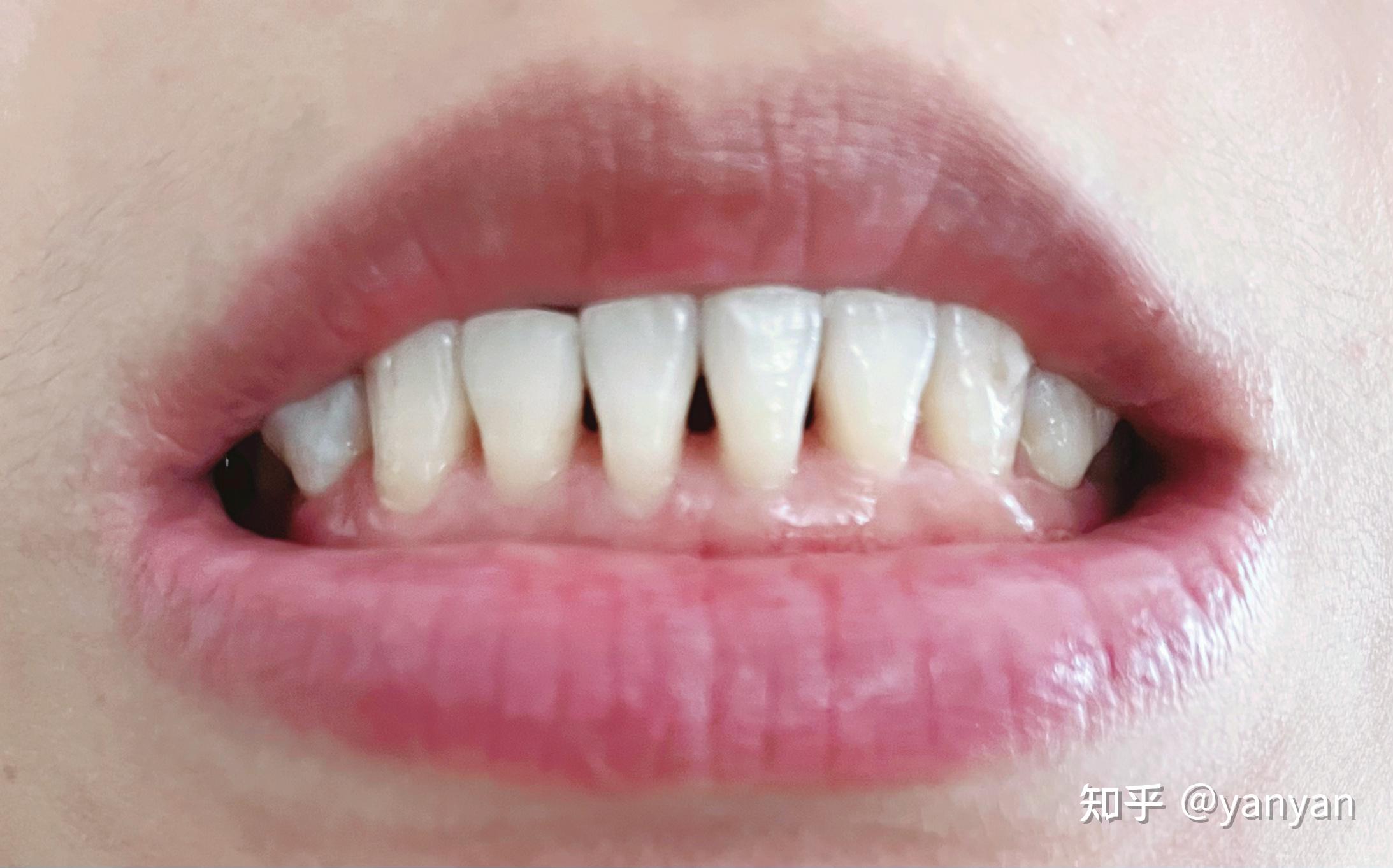 牙周膜龈手术+植骨（PAOO）记录 - 知乎