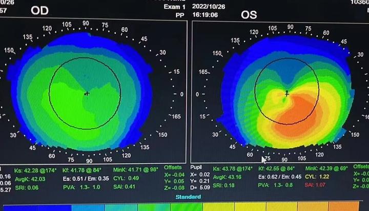 普通RGP解决早期圆锥案例1例 - 知乎