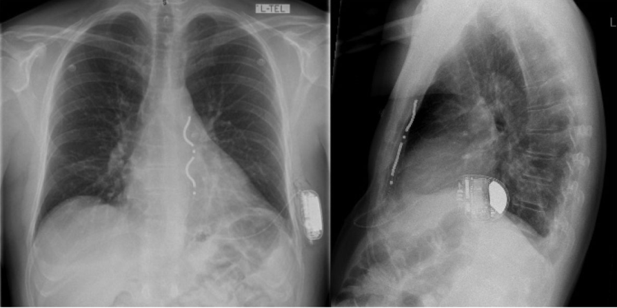 2022 EHRA/HRS立场文件丨血管外ICD的适应证和临床前景 - 知乎
