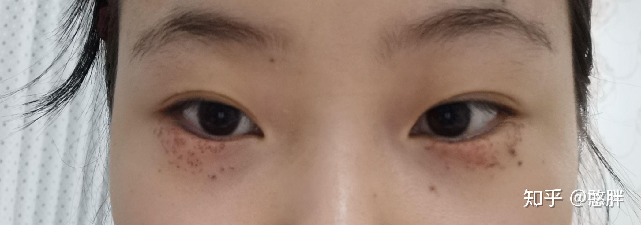 25岁女生长汗管瘤挺久了 最近想去做激光 有相同经历的人么 激光效果怎么样 会留疤痕么 知乎